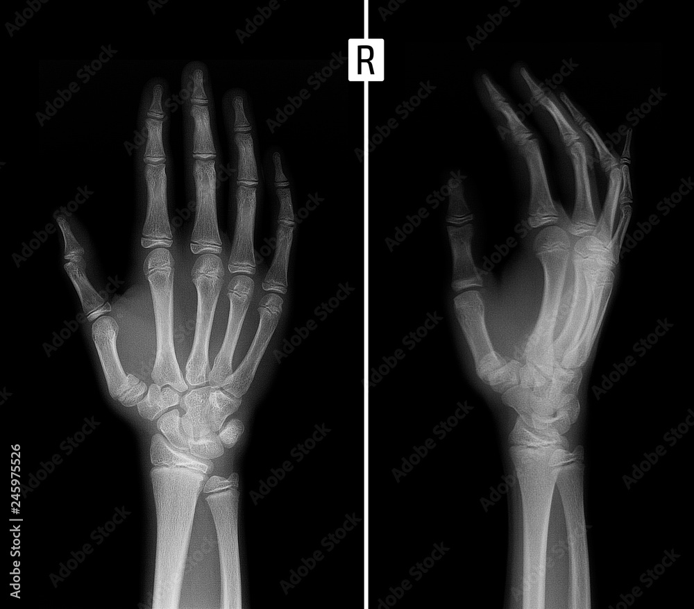 X-ray of the hand. Fracture of the base of the 1st metacarpal bone ...