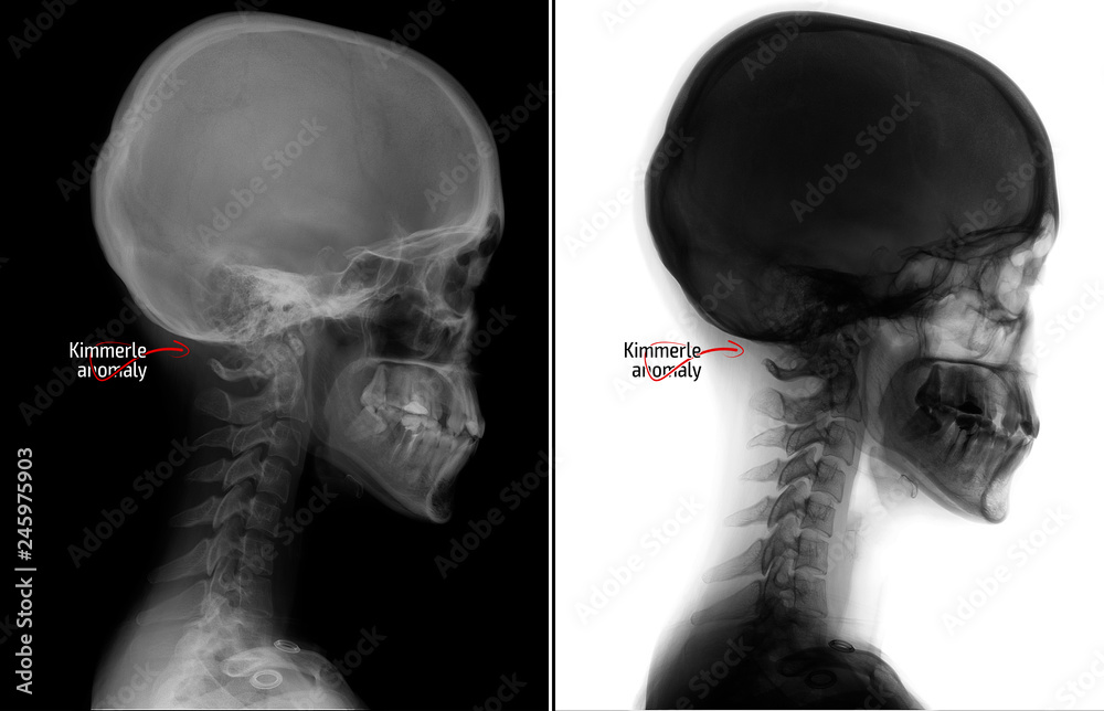 X-ray of the cervical spine. Kimerly anomaly. Cervical dysfunction ...