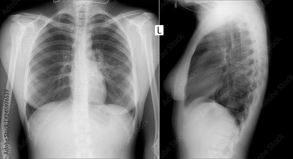 X-ray of the lungs. Pneumonia of the lung left S6. Stock Photo | Adobe ...