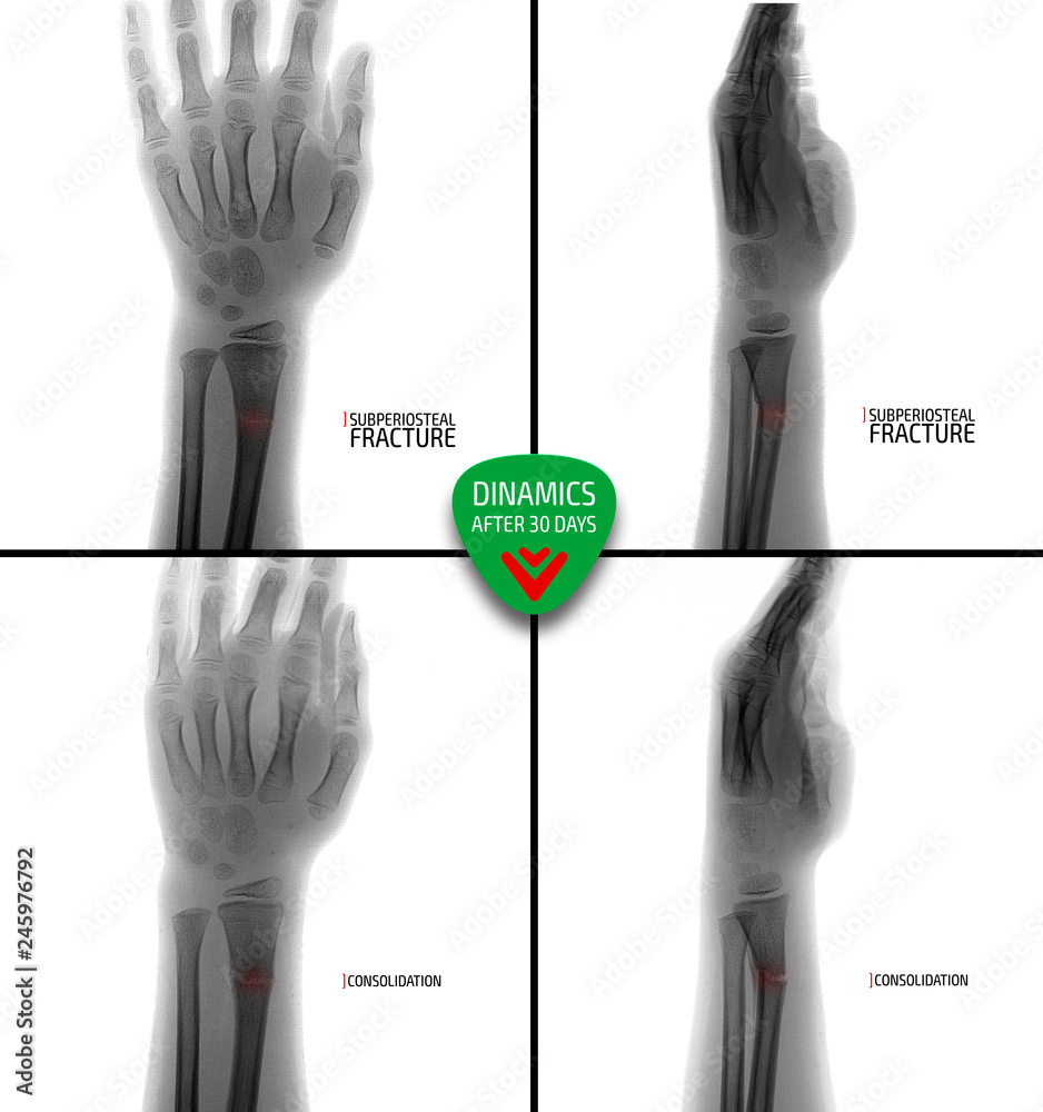 X-ray of the wrist. Subperiosteal fracture of the radius. After 30 days ...