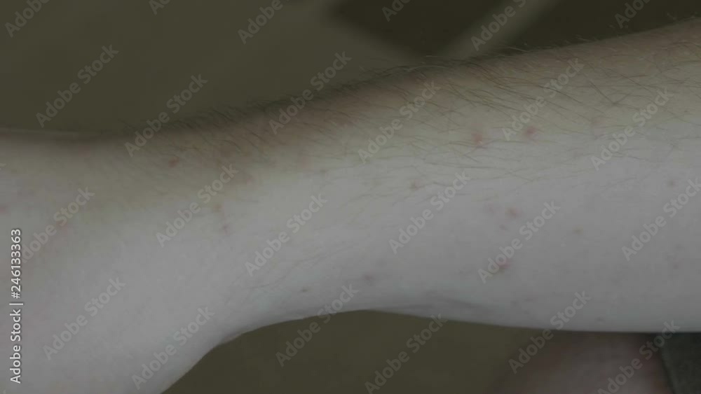 Allergic young man showing his arm with red spots dermal rash vídeo do ...