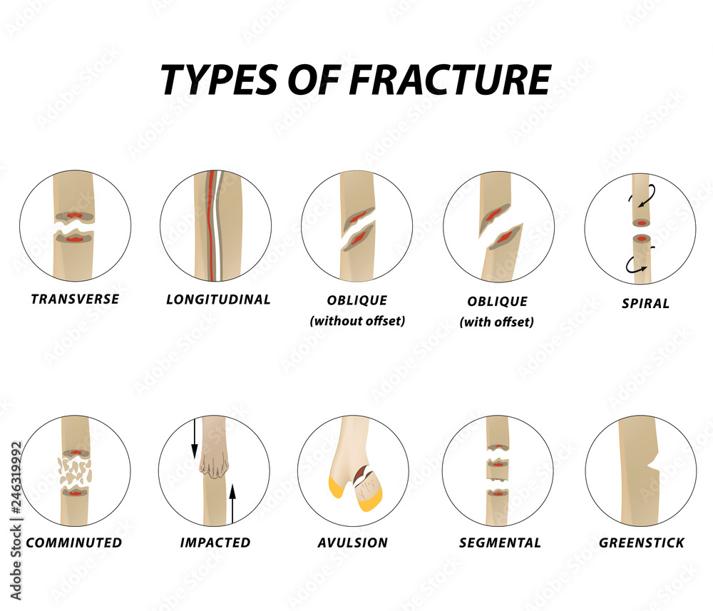 Types of fracture. Fracture bone set. Infographics. Vector illustration ...