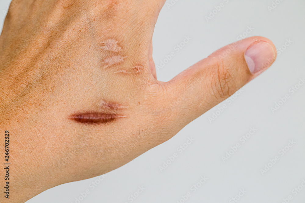 Keloid scar (Hypertrophic Scar) on man hand skin after accident ...