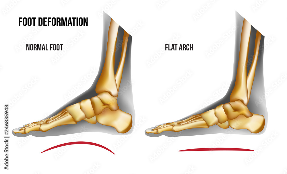 Anatomy flat foot arch medial view Stock Vector | Adobe Stock