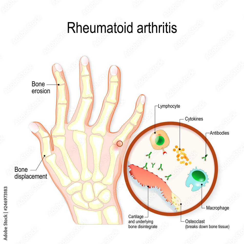 Rheumatoid Arthritis (RA) is an auto immune disease and inflammatory ...