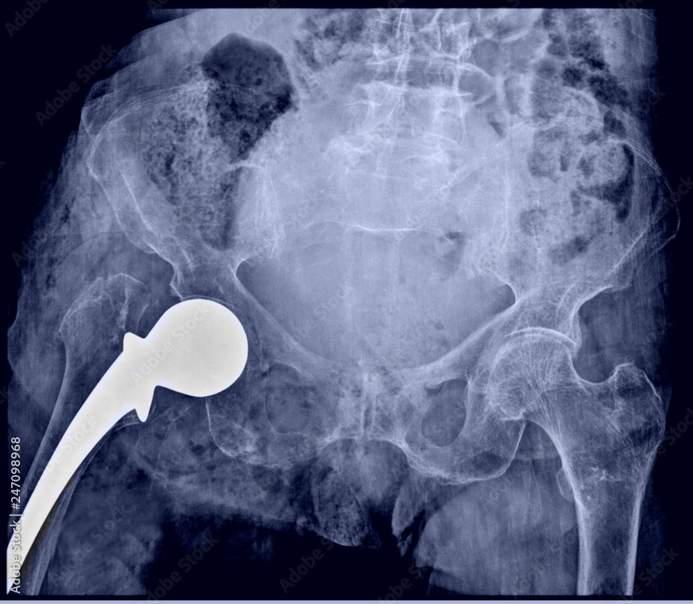 radiografia de la articulacion de la cadera – Stock-Foto | Adobe Stock