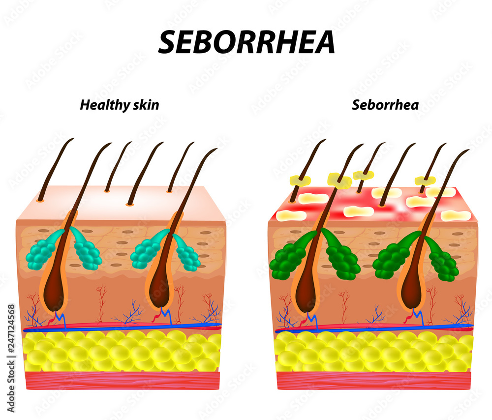 Seborrhea skin and hair. Dandruff seborrheic dermatitis. Eczema ...