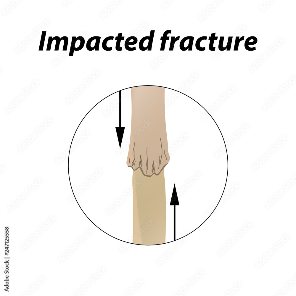 Impacted fracture Bone. Infographics. Vector illustration on a lined ...