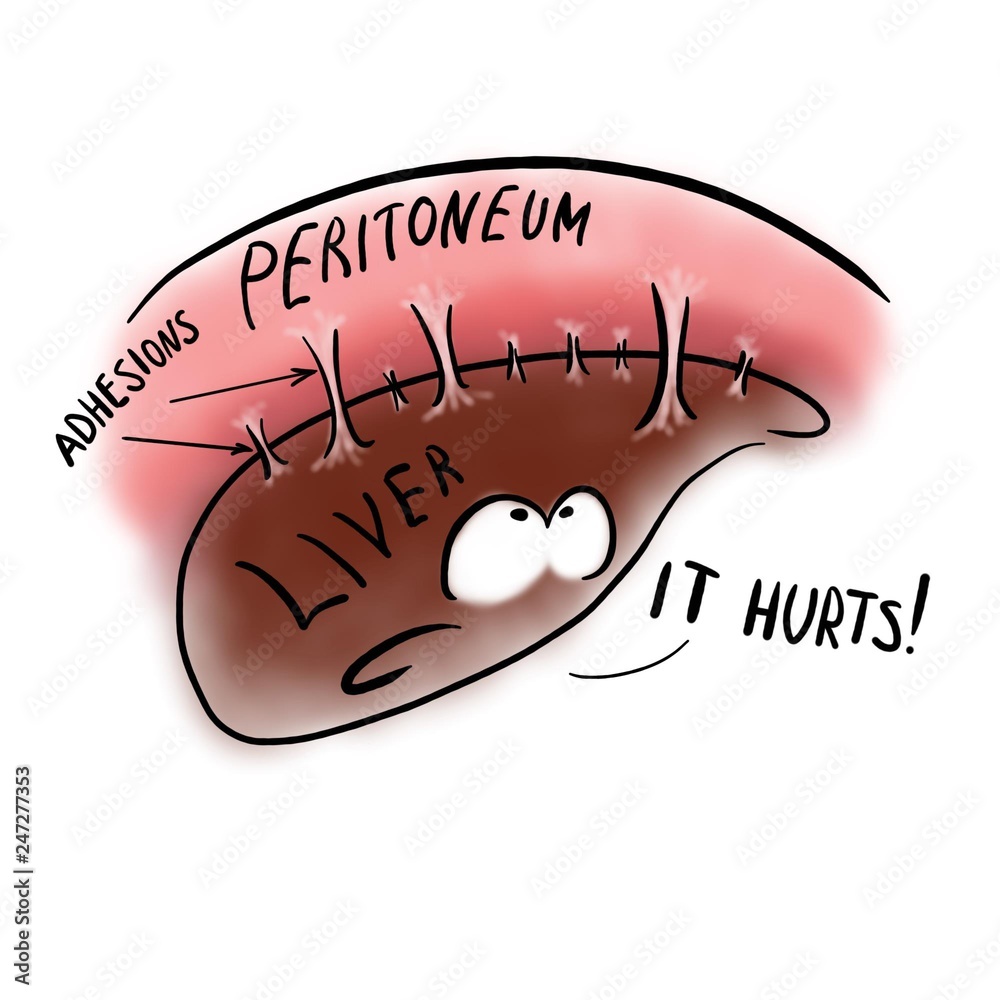 Liver and perihepatitis Stock Illustration | Adobe Stock