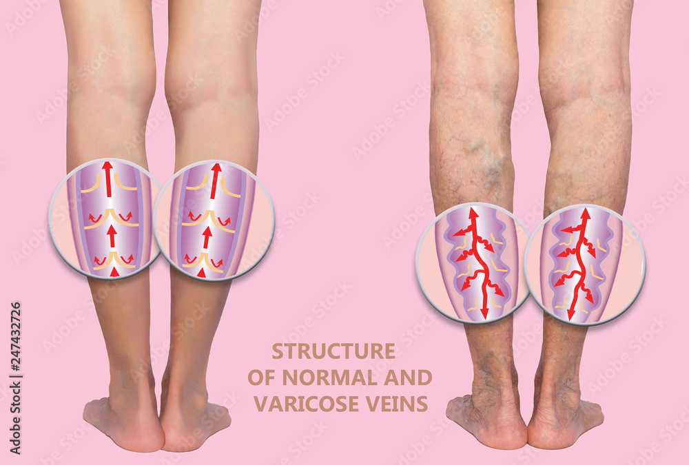 Varicose veins on a female senior legs. The structure of normal and ...