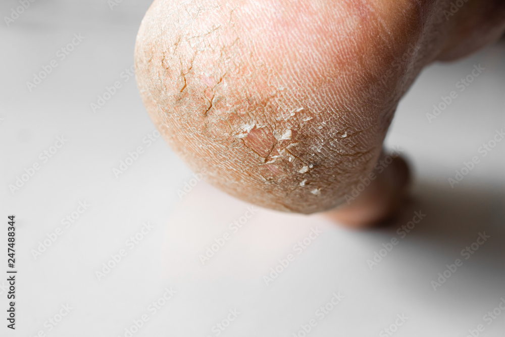 Cracked skin on heels. Dry skin of the feet. Stock Photo | Adobe Stock