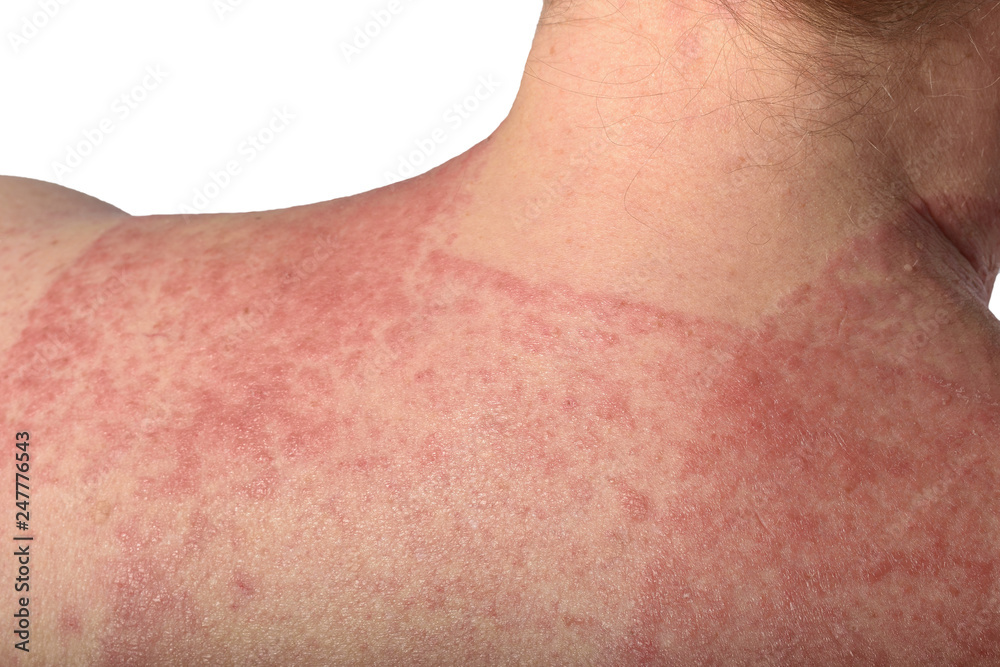 Pflasterallergie Rücken Nahaufnahme Stock-Foto | Adobe Stock