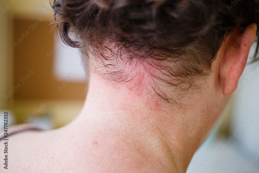 Psoriasis On Back Of Neck