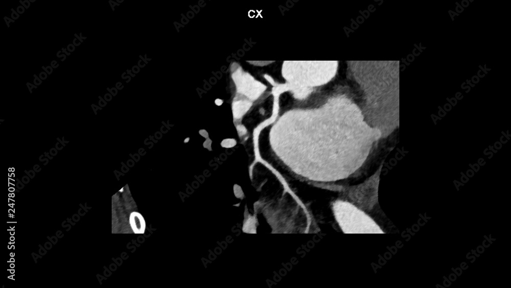 Left circumflex artery is an artery(LCX) branches curve with computed ...