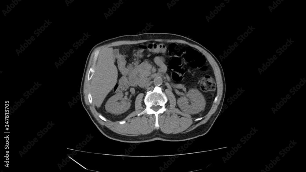 Computed Tomography Abdomen (CT SCAN) Finding isodensity splenic mass ...