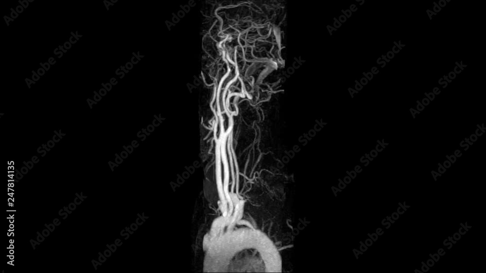 MRA Brain (Magnetic Resonance Angiography)of the blood vessels in the ...