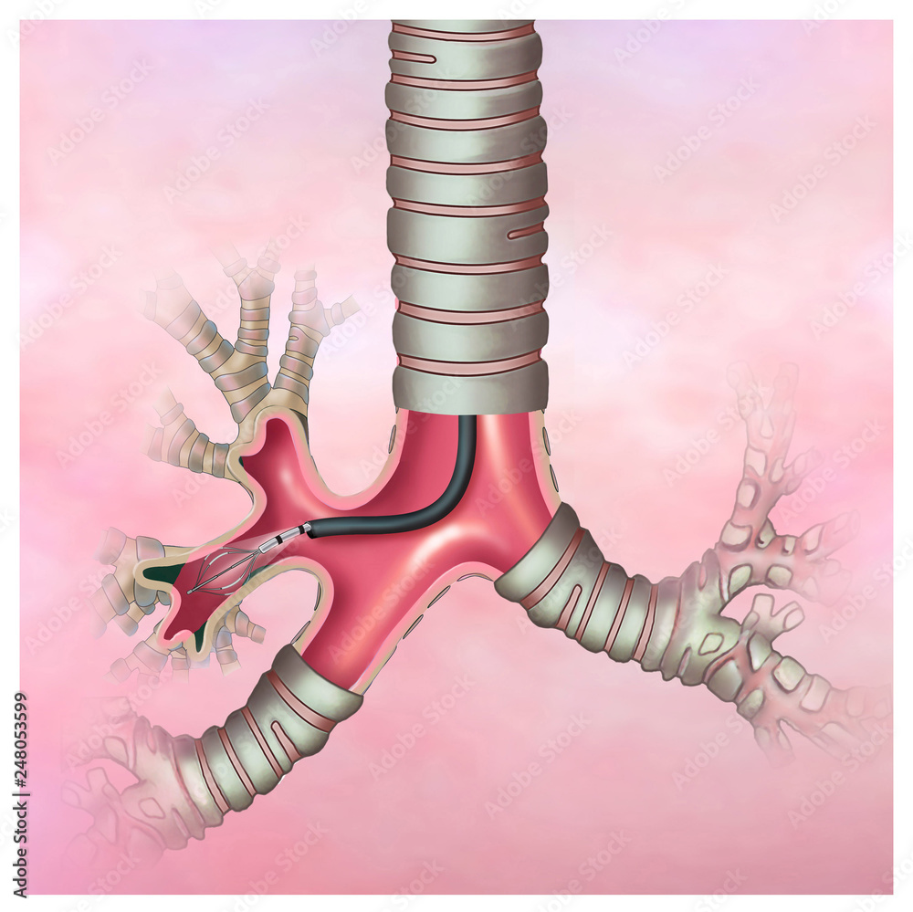 Examen pulmonar con broncoscopia flexible Stock Illustration | Adobe Stock