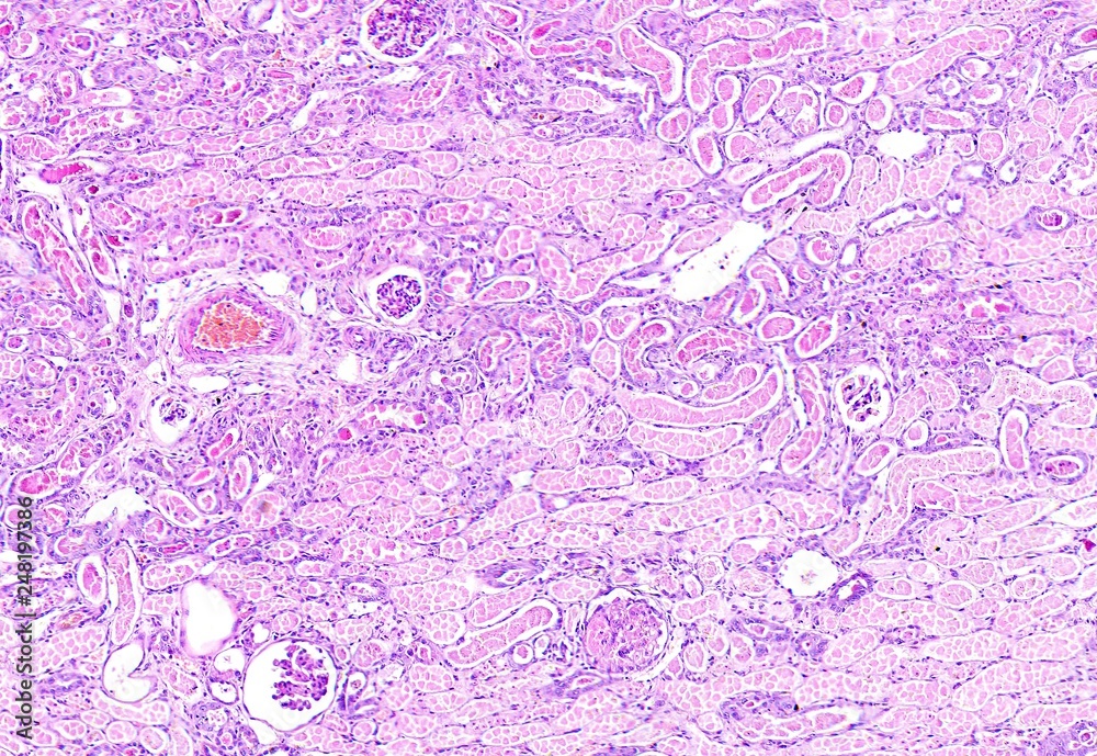 Histology of human tissue, show cortical necrosis of kidney as seen ...
