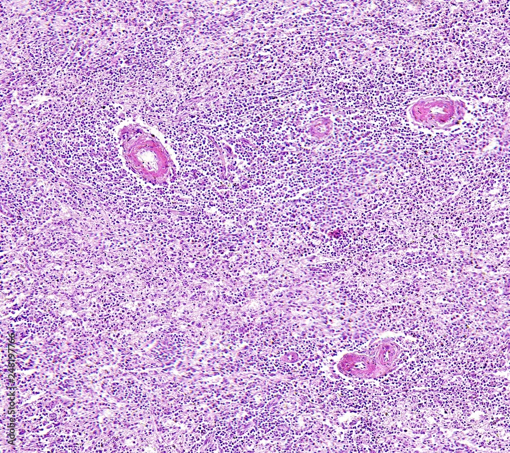 Histology of human tissue, show central artery hyaline degeneration of ...