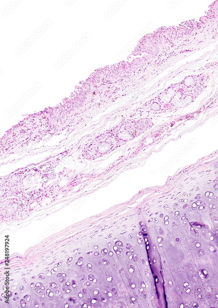 Histology of human tissue, show tracheitis and squamous metaplasia of ...