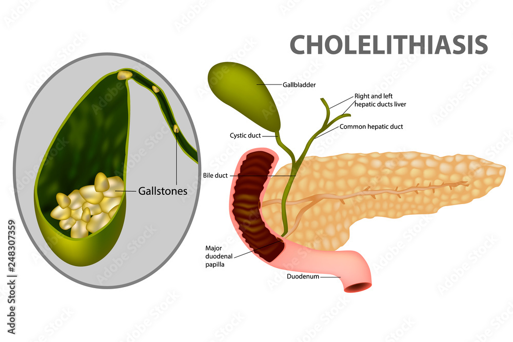 Gallstone (Cholelithiasis) is a chronic recurrent hepatobiliary disease ...