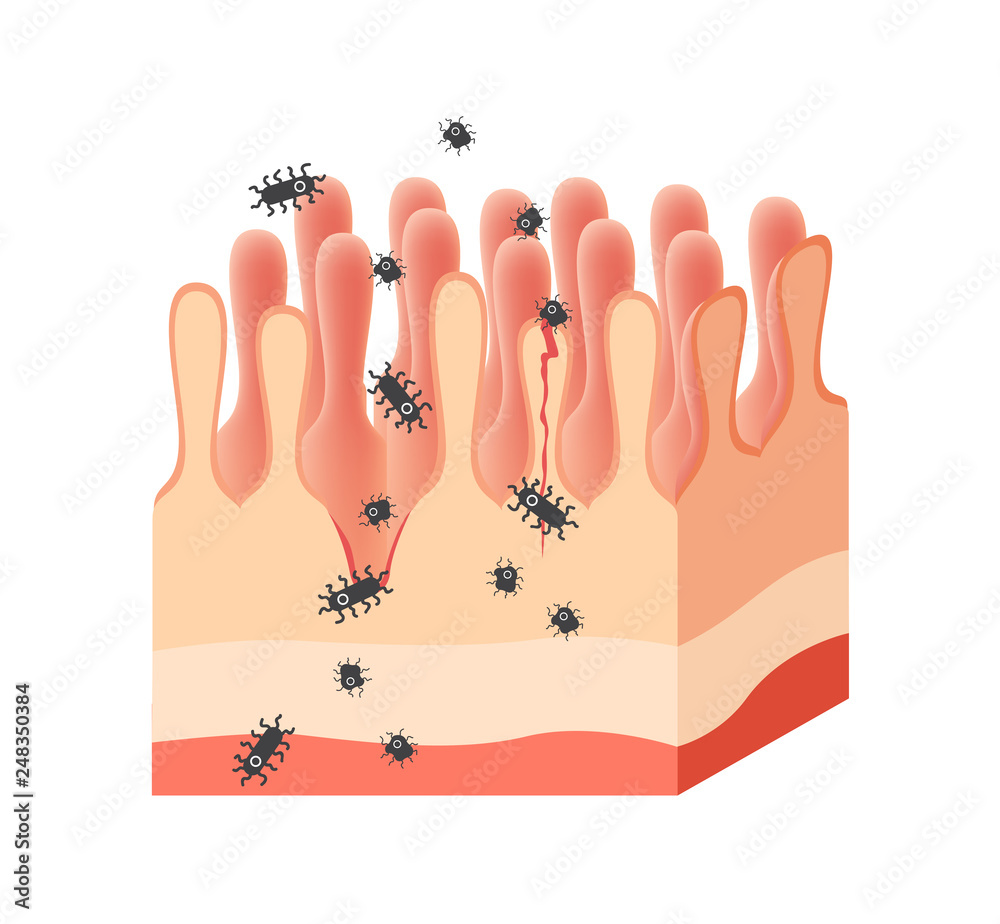 Celiac disease Small intestine lining damage. good and damaged villi ...