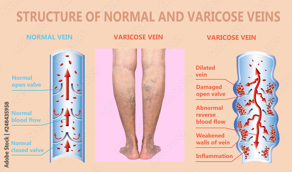 Varicose veins on a female senior legs. The structure of normal and ...