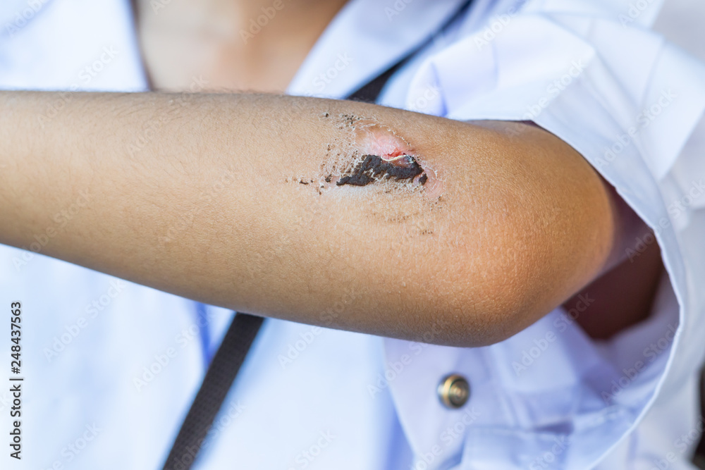 wound have scab on the elbow of the child Stock Photo | Adobe Stock