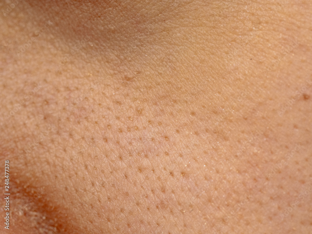 Large Pores On Nose And Cheeks