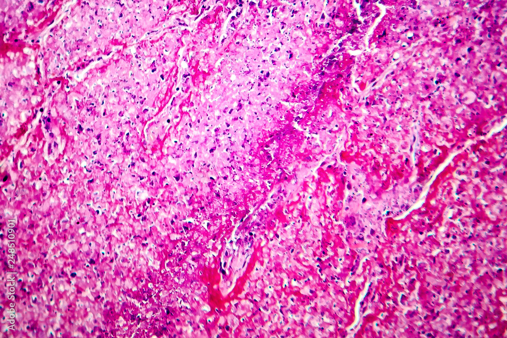 Caseation of human tuberculosis granuloma, light micrograph, photo ...
