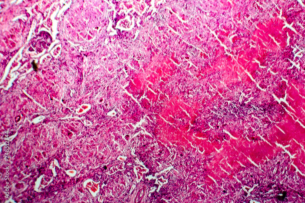 Miliary tuberculosis, light micrograph, photo under microscope Stock ...