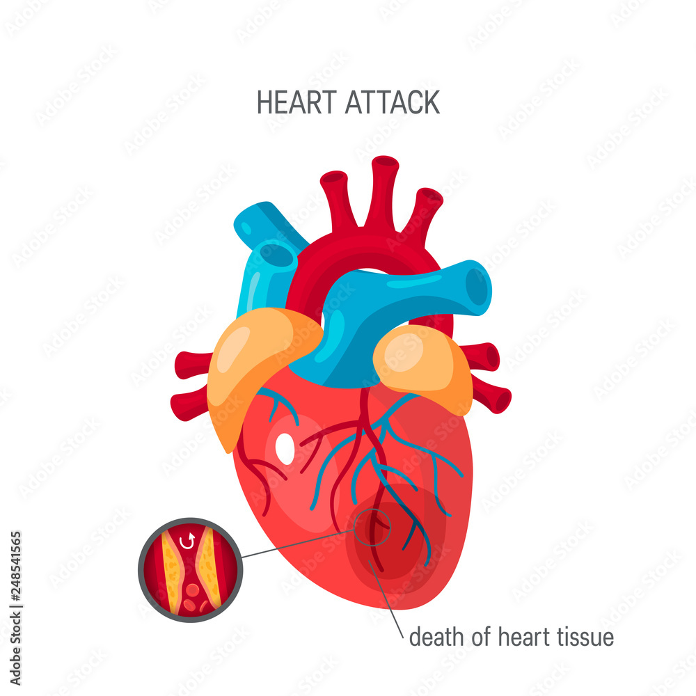 Heart attack concept in flat style, vector Stock Vector | Adobe Stock
