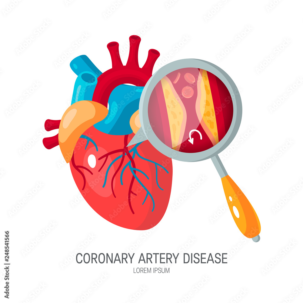 Coronary artery disease concept in flat style Stock Vector | Adobe Stock