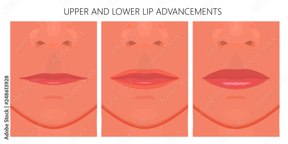 Vector illustration. Upper and Lower Lip Advancements on woman face ...