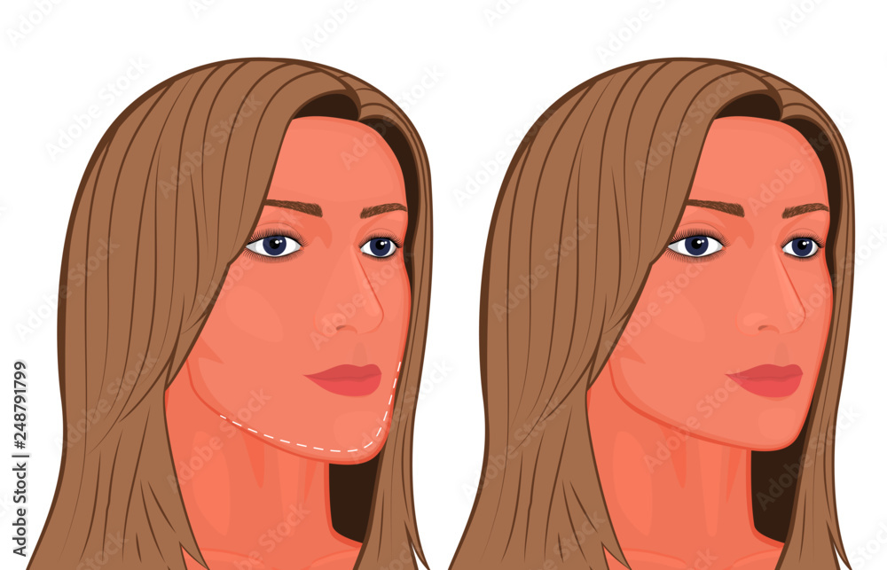 Vector illustration. A young white female face before and after plastic ...
