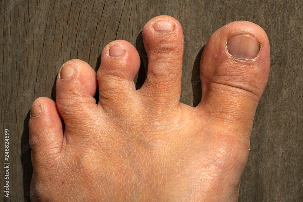 Crooked Toe