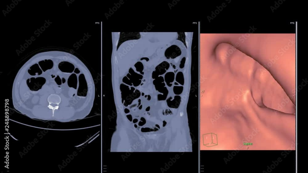 CT colonography is highly sensitive for colorectal cancer, 3D rendering ...