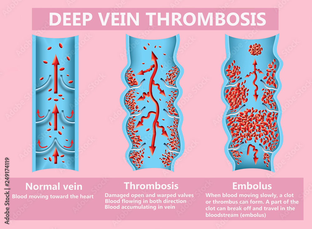 thrombosis. From Normal blood flow to Blood clot formation Stock ...