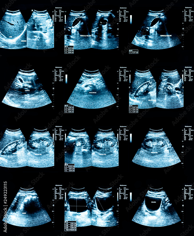Ultrasound Scan Image of abdomen. Medical diagnostic Stock Photo ...