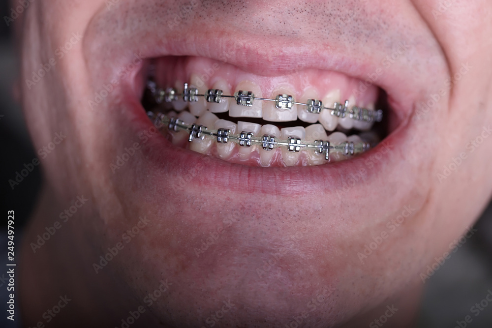 Disgusting Teeth With Braces