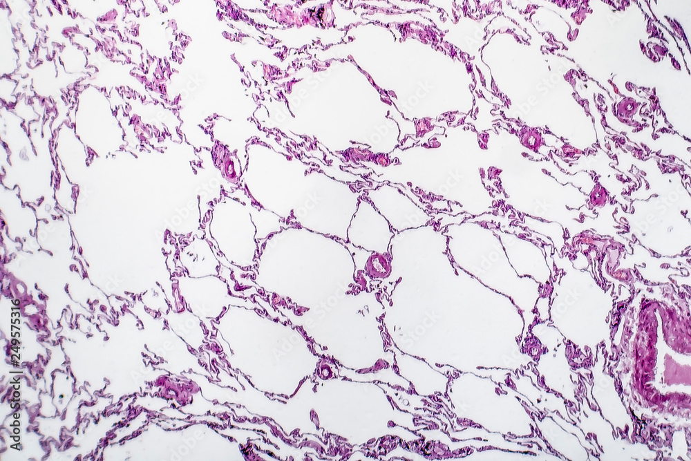 Histopathology of lung emphysema, light micrograph, photo under ...