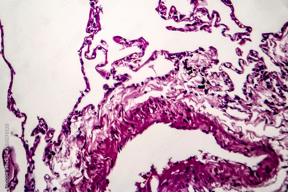 Histopathology of lung emphysema, light micrograph, photo under ...