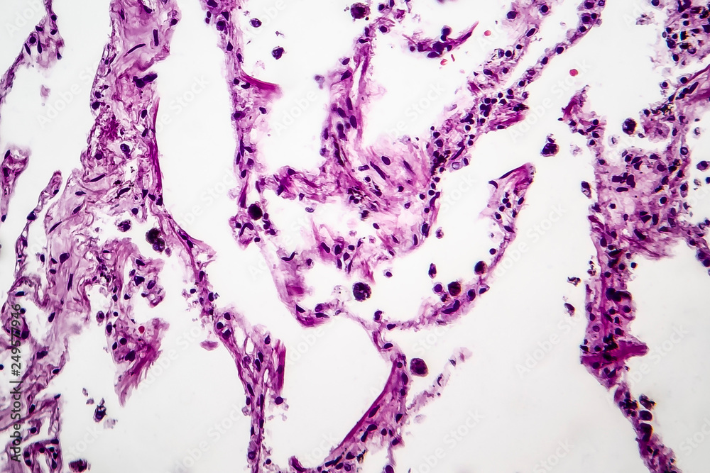 Fototapeta kuchenna Histopathology of lung emphysema, light micrograph ...
