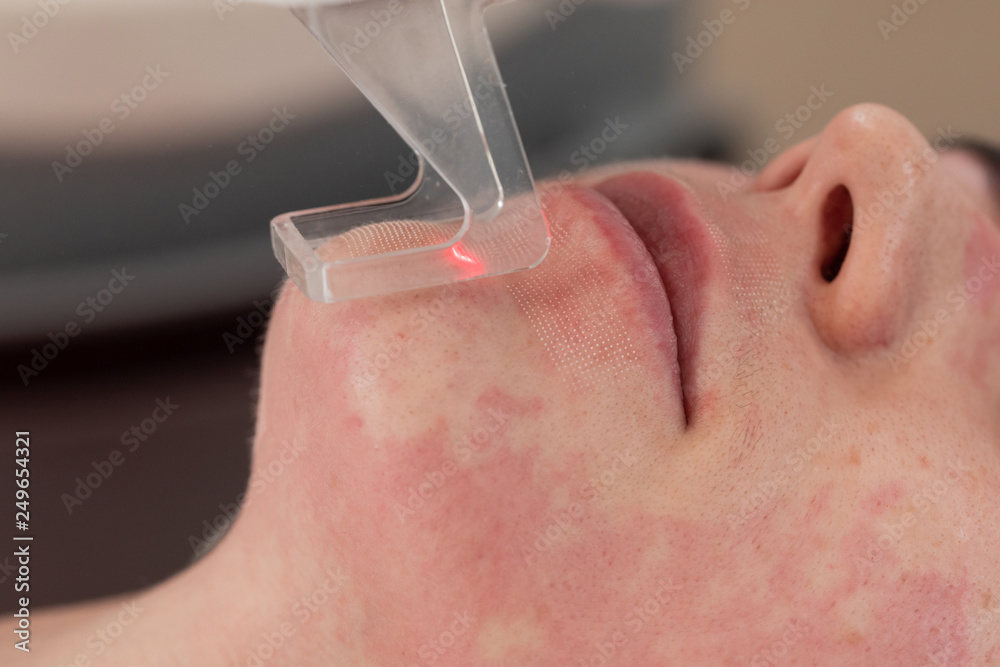 Laser rejuvenating facial face treatment at cosmetology clinic. Young ...