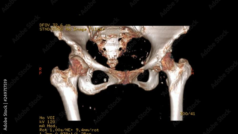 CT SCAN of Both hip joint 3D rendering image Rotating on the screen ...