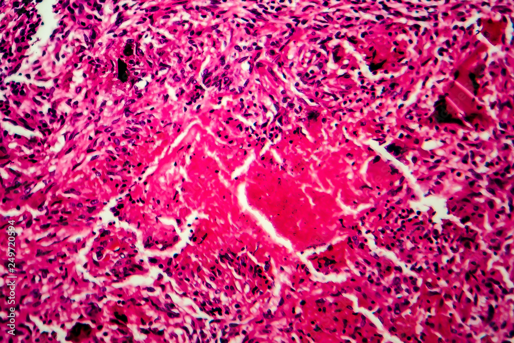 Miliary tuberculosis, light micrograph, photo under microscope Stock ...