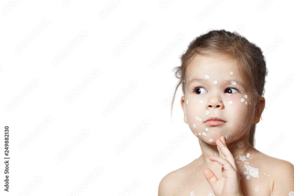 Closeup face cute little girl with varicella virus or chickenpox bubble ...