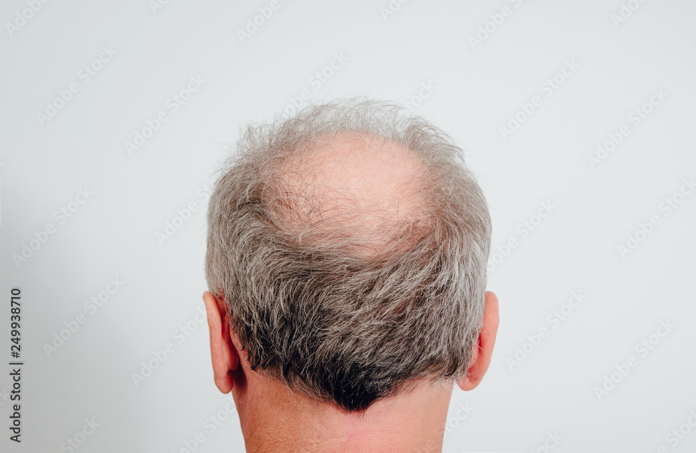 Foto de Rear view of a male head without hair. Hair loss concept, bird ...