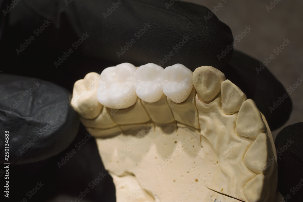Plaster model of the upper and lower jaw of the patient of dental ...