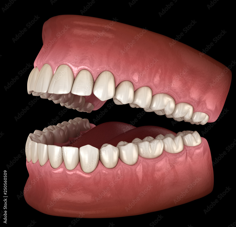 Dental anatomy - Opened Dentures. Medically accurate dental 3D ...